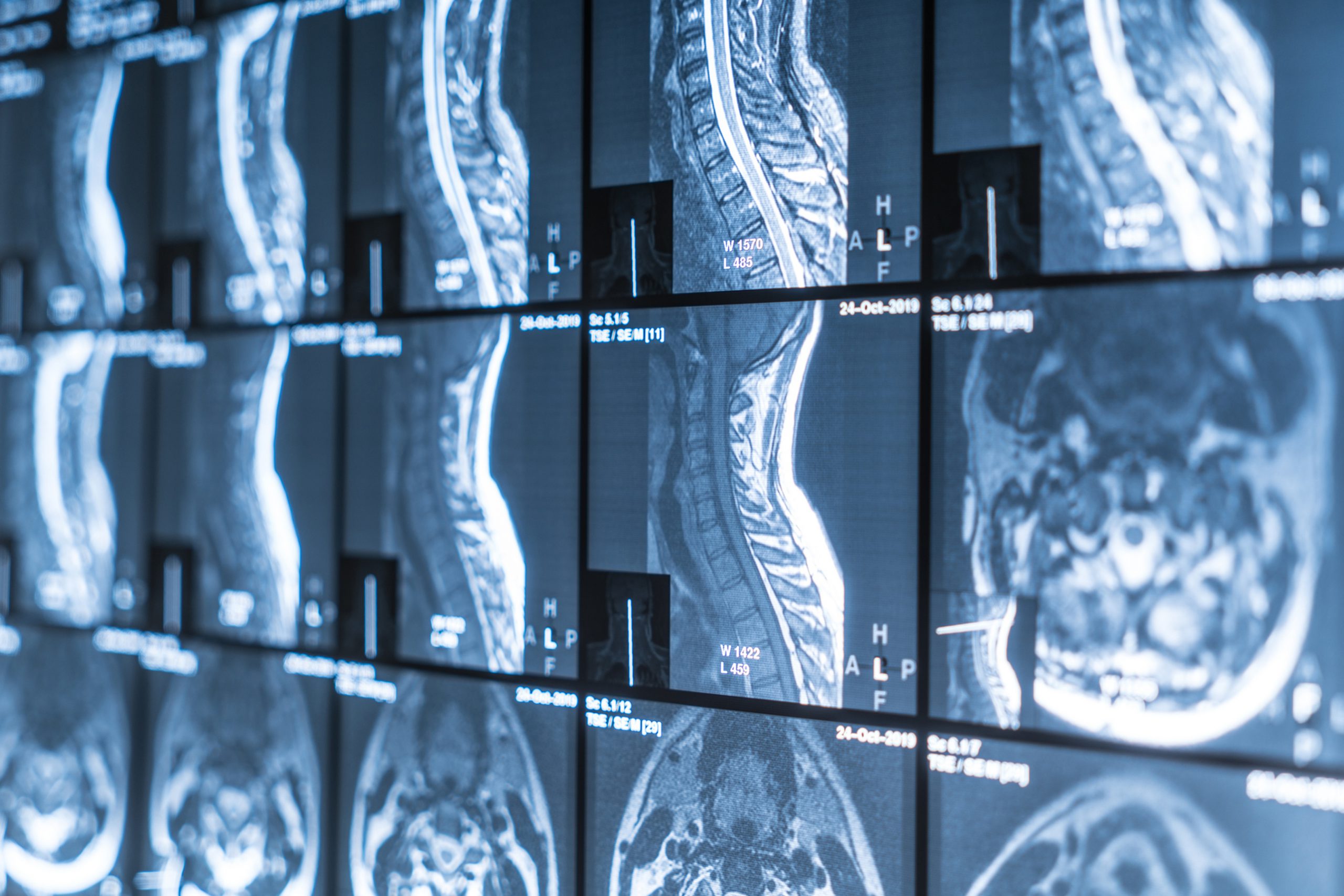 A New Research Project to Improve Screening for Serious Spinal ...